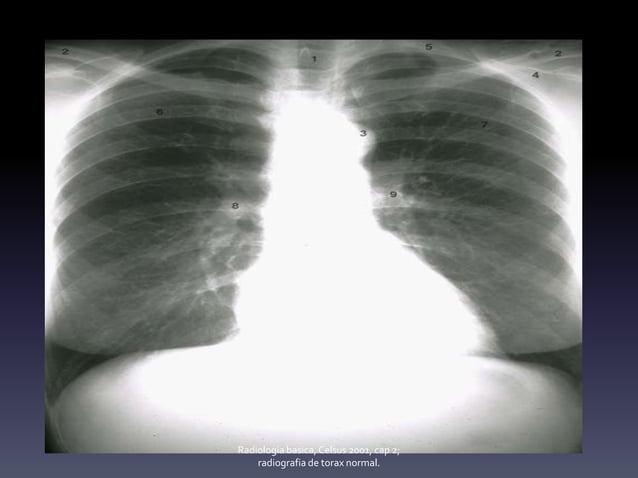 Rx de torax normal | PPTX