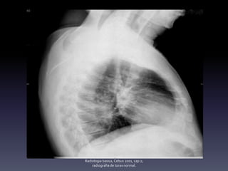 Rx de torax normal | PPTX
