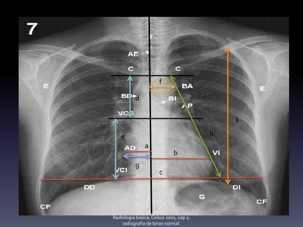 Rx de torax normal