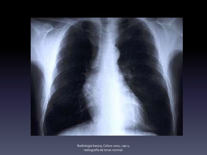 Rx de torax normal