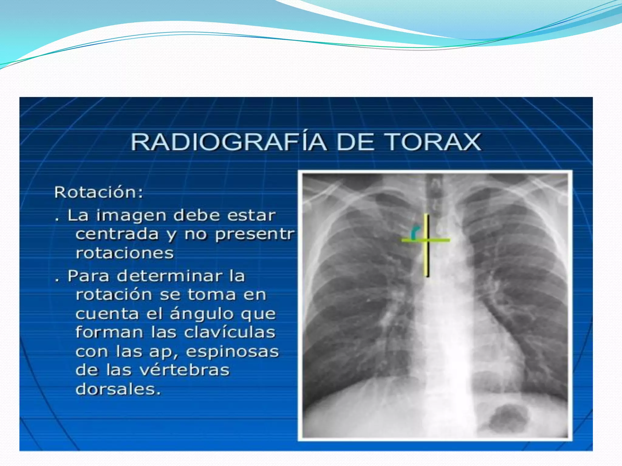 Radiologia de torax normal. lectura de una Rx | PDF | Medical Health