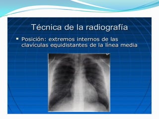Radiologia de torax normal. lectura de una Rx | PDF