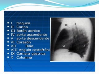 Radiologia de torax normal. lectura de una Rx | PDF