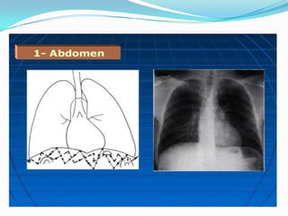 Radiologia de torax normal. lectura de una Rx | PDF