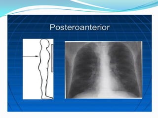 Radiologia de torax normal. lectura de una Rx | PDF