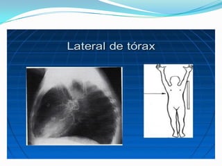 Radiologia de torax normal. lectura de una Rx | PDF