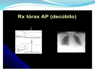 Radiologia de torax normal. lectura de una Rx | PDF