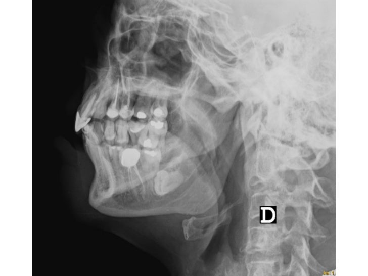 Rx maxilar inferior 01