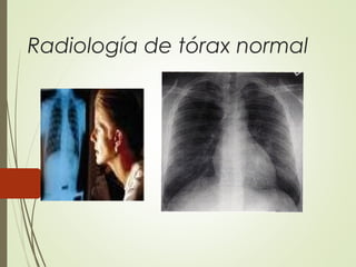 Radiografia normal de torax | PPT