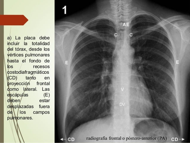 Radiografia normal de torax