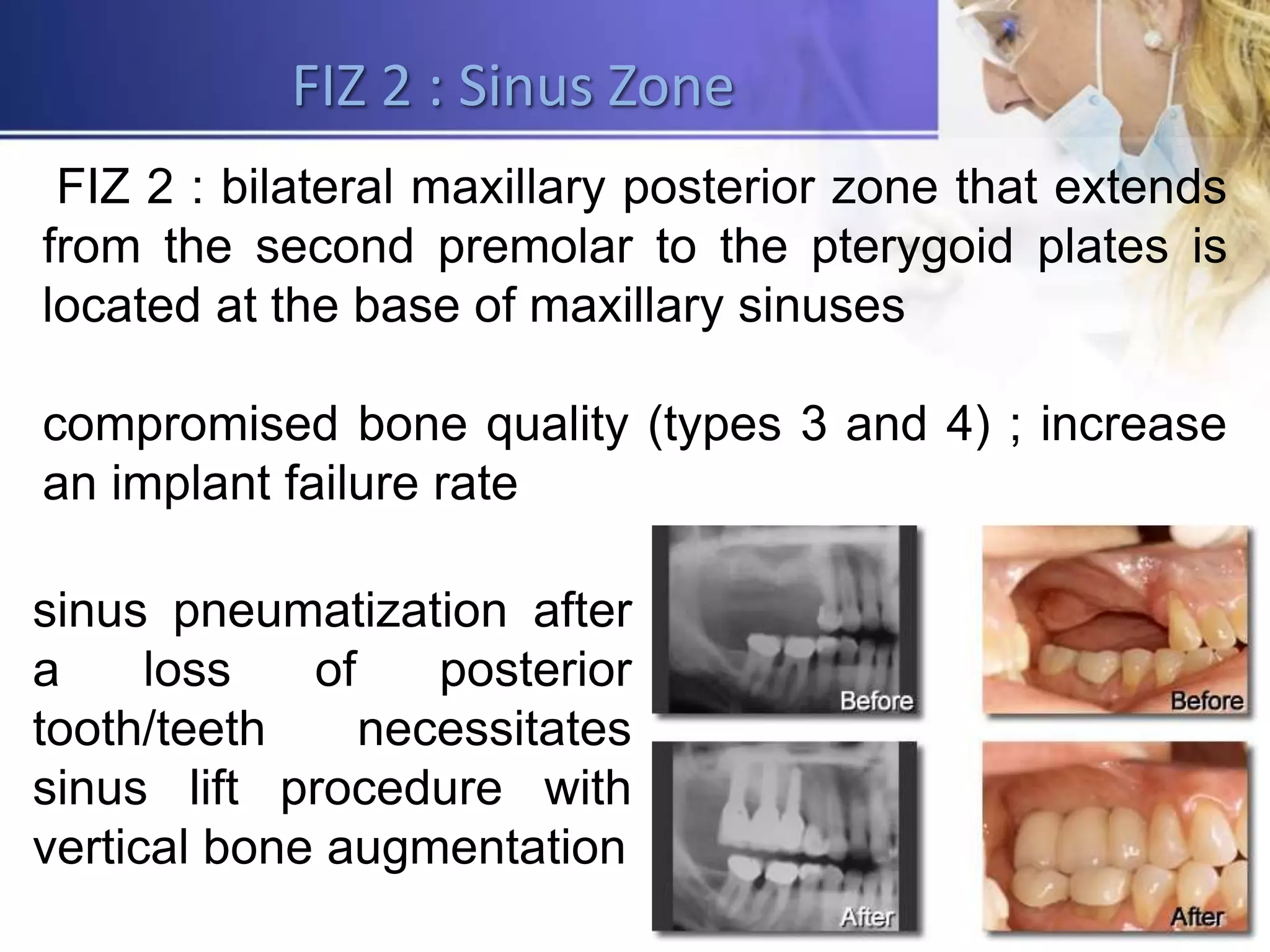 Treatment plan for Implants in funtional zone | PPTX