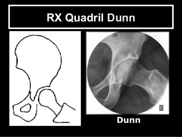 Avaliação Radiologica do Quadril Doloroso