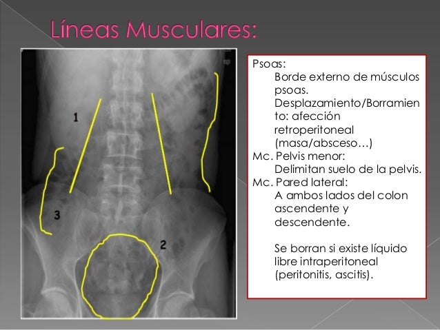 Rx simple de abdomen