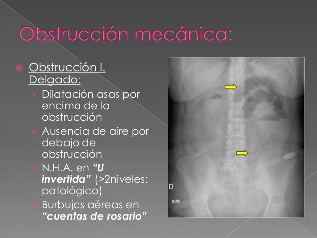 Rx simple de abdomen