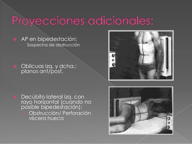 Rx simple de abdomen