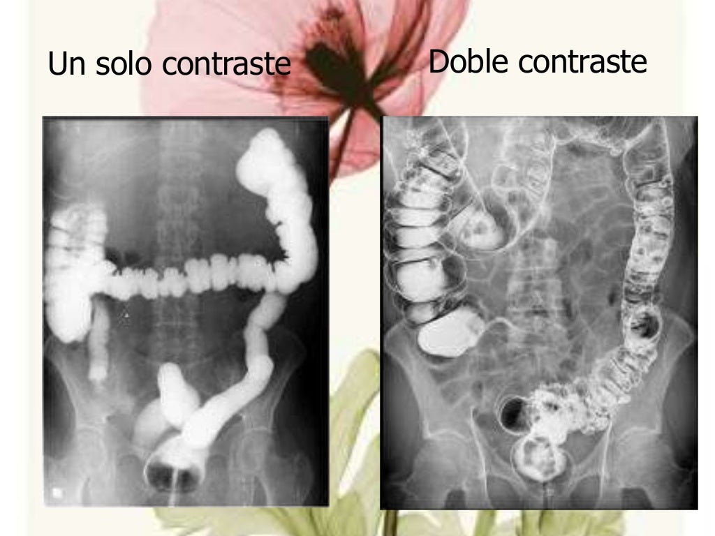 Rx simple y contrastada de abdomen