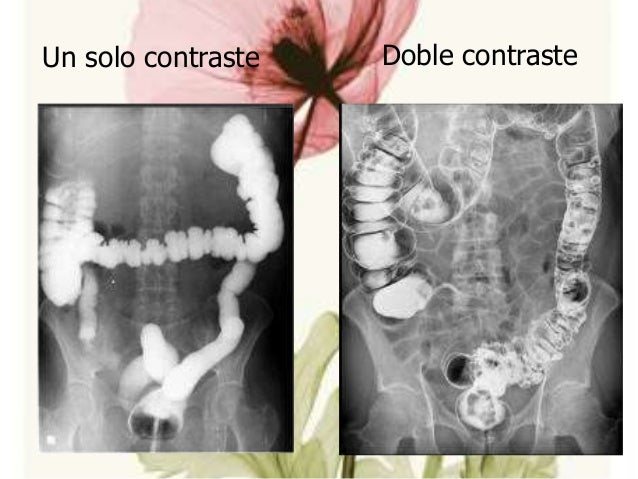Radiografia de doble contraste - donbatman