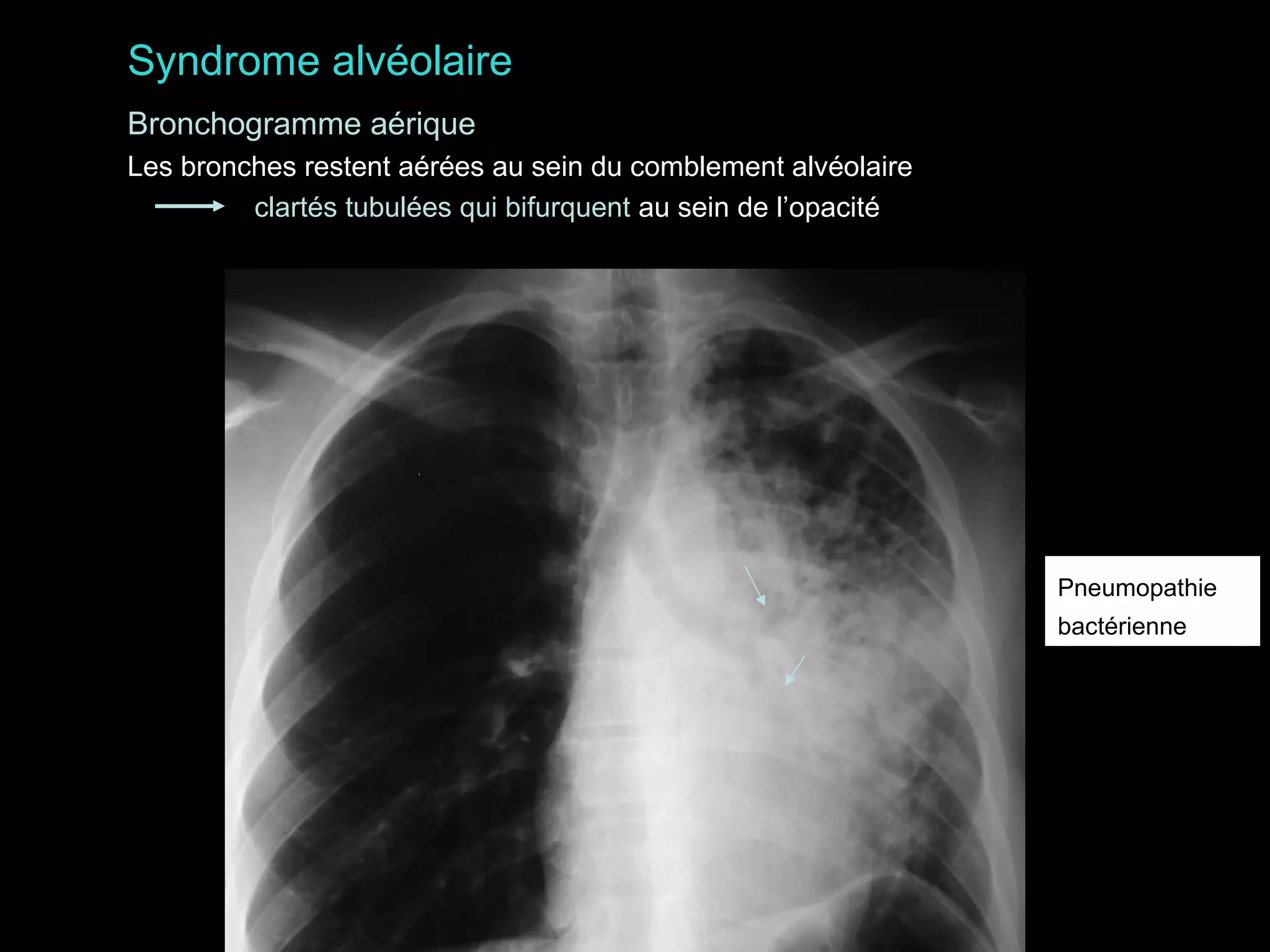 Rx thoracique les grands syndromes