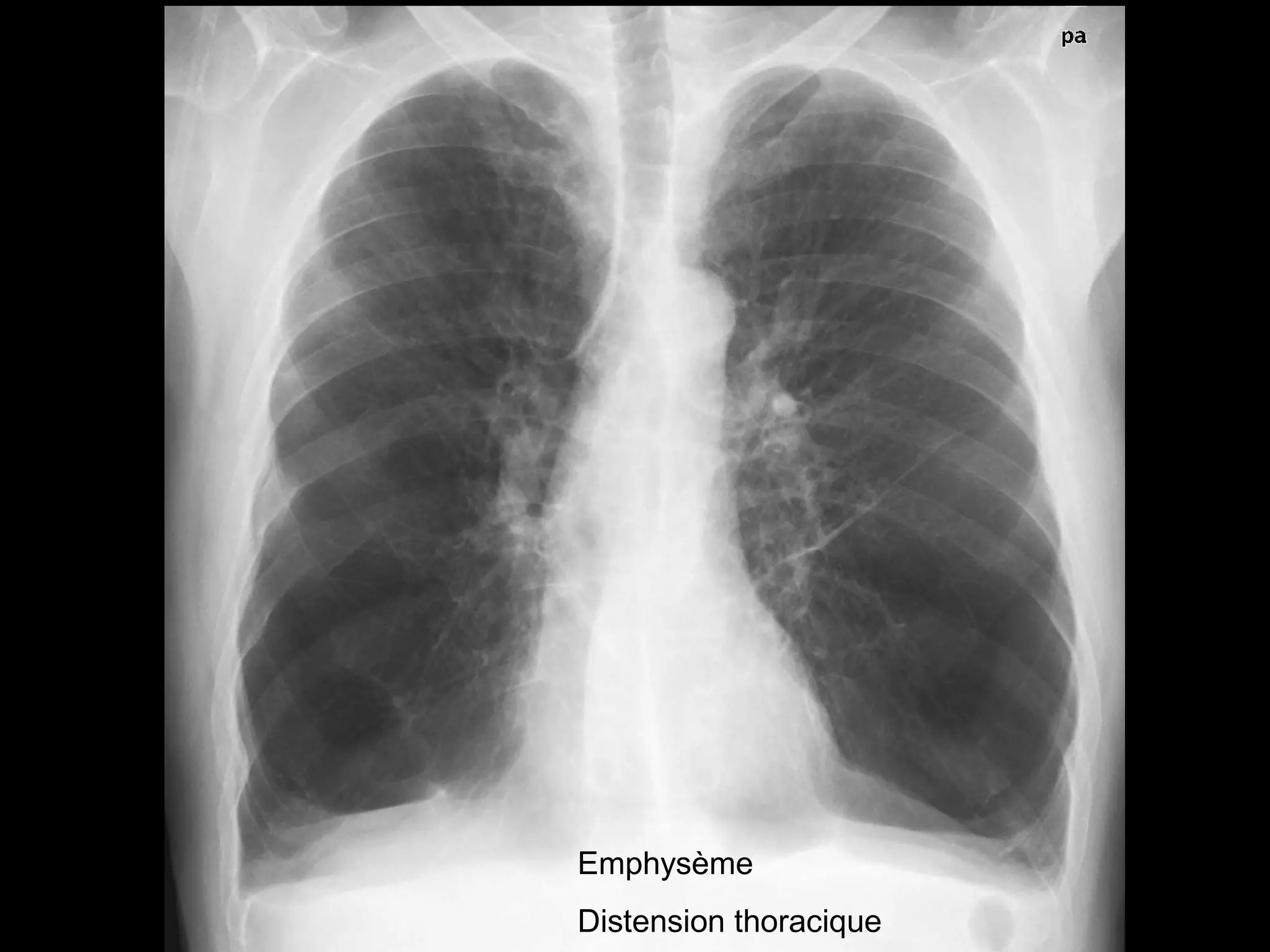 Rx thoracique les grands syndromes