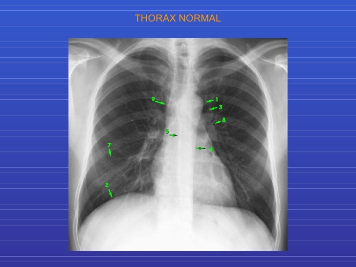 Rx Thorax