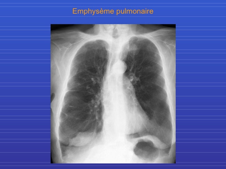 Emphysème Pulmonaire Phase Finale – WVPOX
