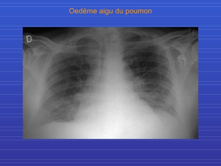 Rx Thorax