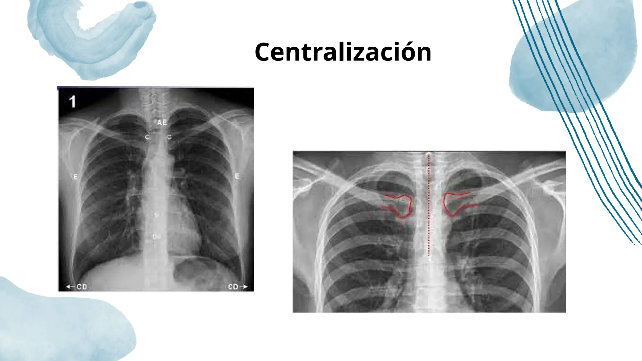 RX TORAX para interpretación de radiografía.pptx
