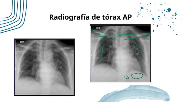 RX TORAX para interpretación de radiografía.pptx