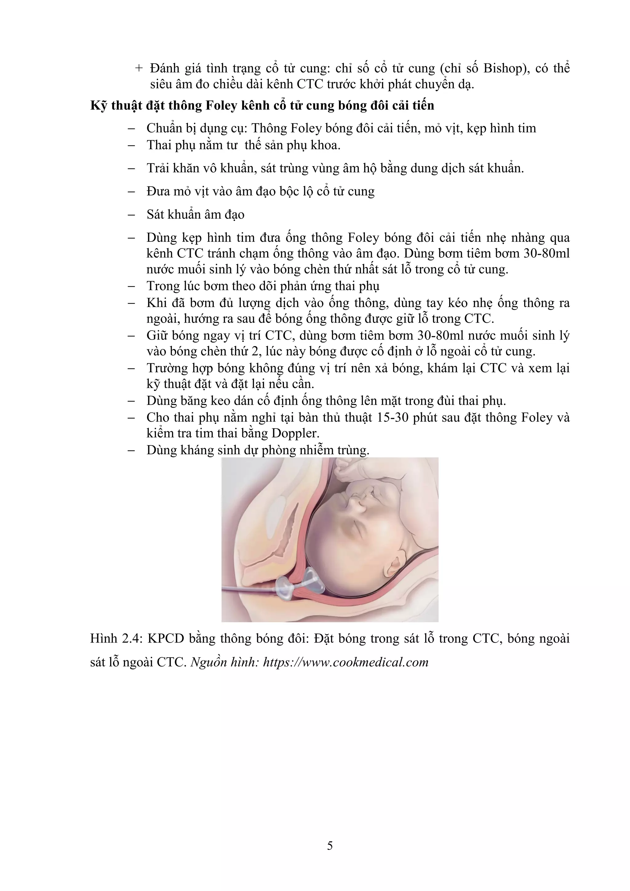 khởi phát chuyển dạ | PDF