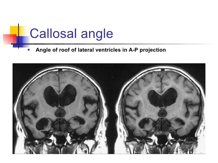 Normal Pressure Hydrocephalus