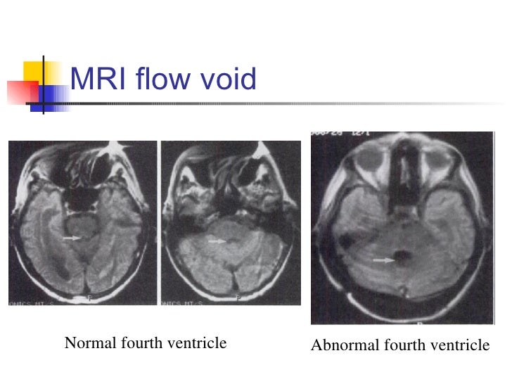 Normal Pressure Hydrocephalus
