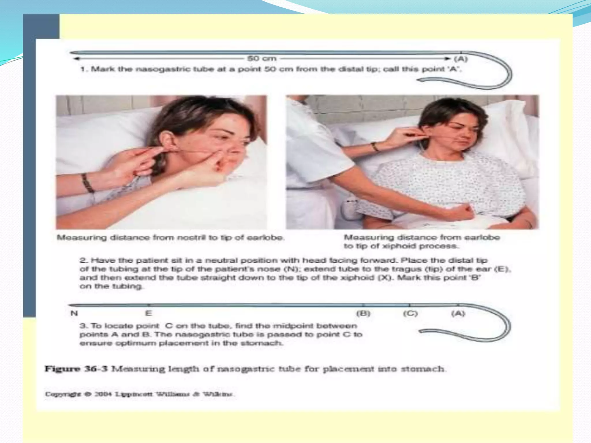 Ryles tube insertion | PPTX