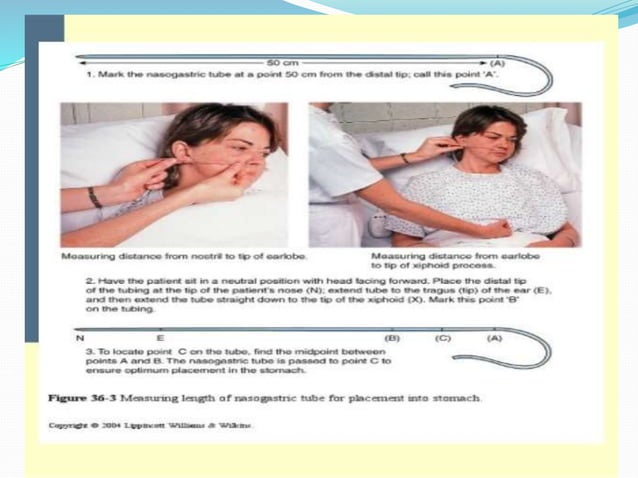 Ryles tube insertion | PPTX