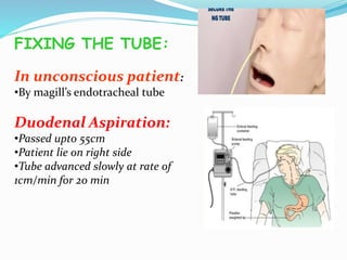 Nasogastric Tube Procedure And Nursing Diagnosis RNspeak, 52% OFF