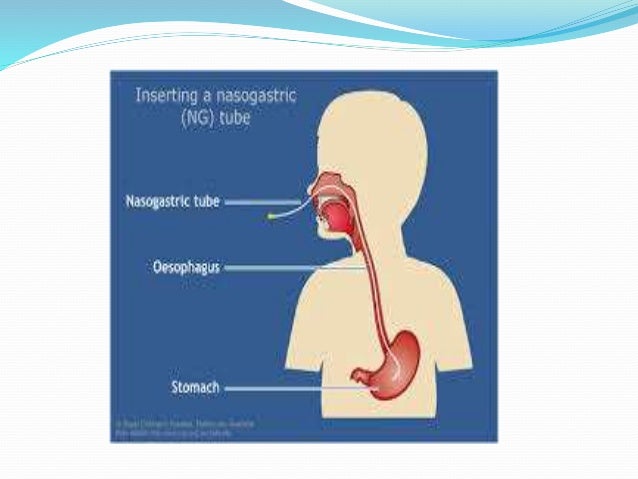 Ryles tube insertion