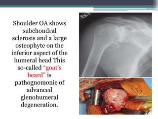 shoulder arthroplasty | PPTX