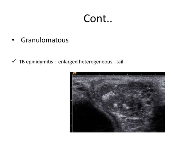 imaging of scrotal diseases | PPTX | Infertility | Reproductive Health