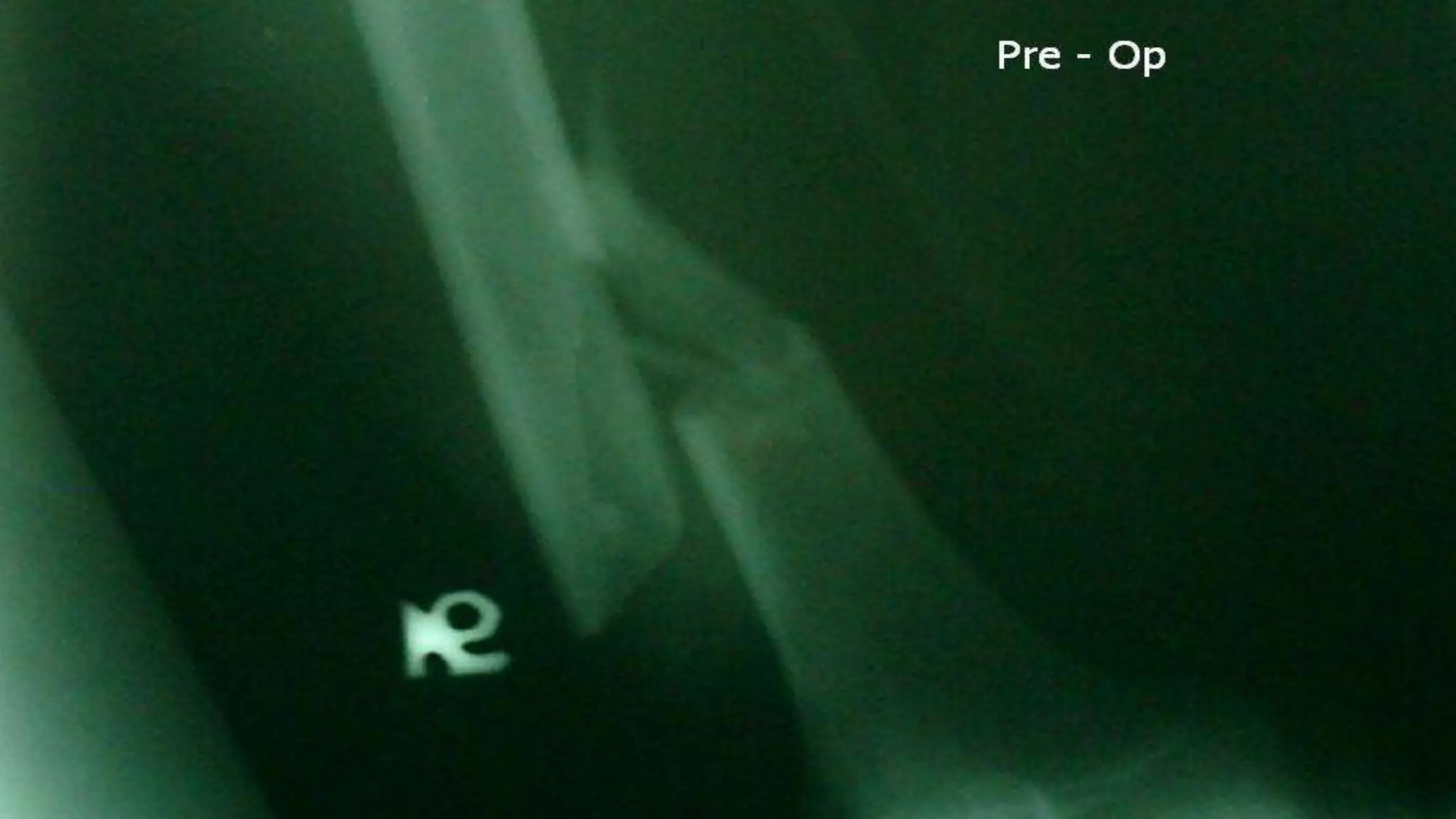 Femur retrograde nailing procedure | PPTX