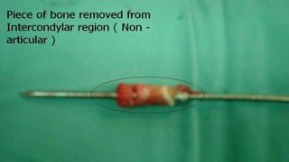 Femur retrograde nailing procedure | PPT