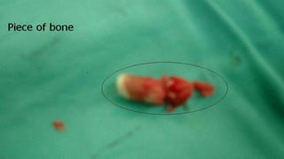 Femur retrograde nailing procedure | PPT