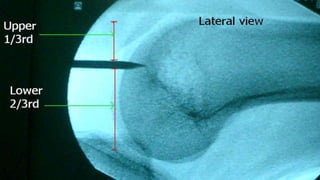 Femur retrograde nailing procedure | PPTX