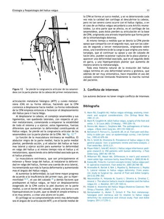 Hallux Valgus | PDF