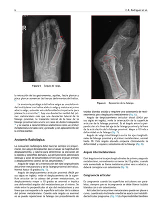 Hallux Valgus | PDF