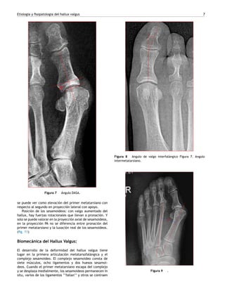Hallux Valgus | PDF