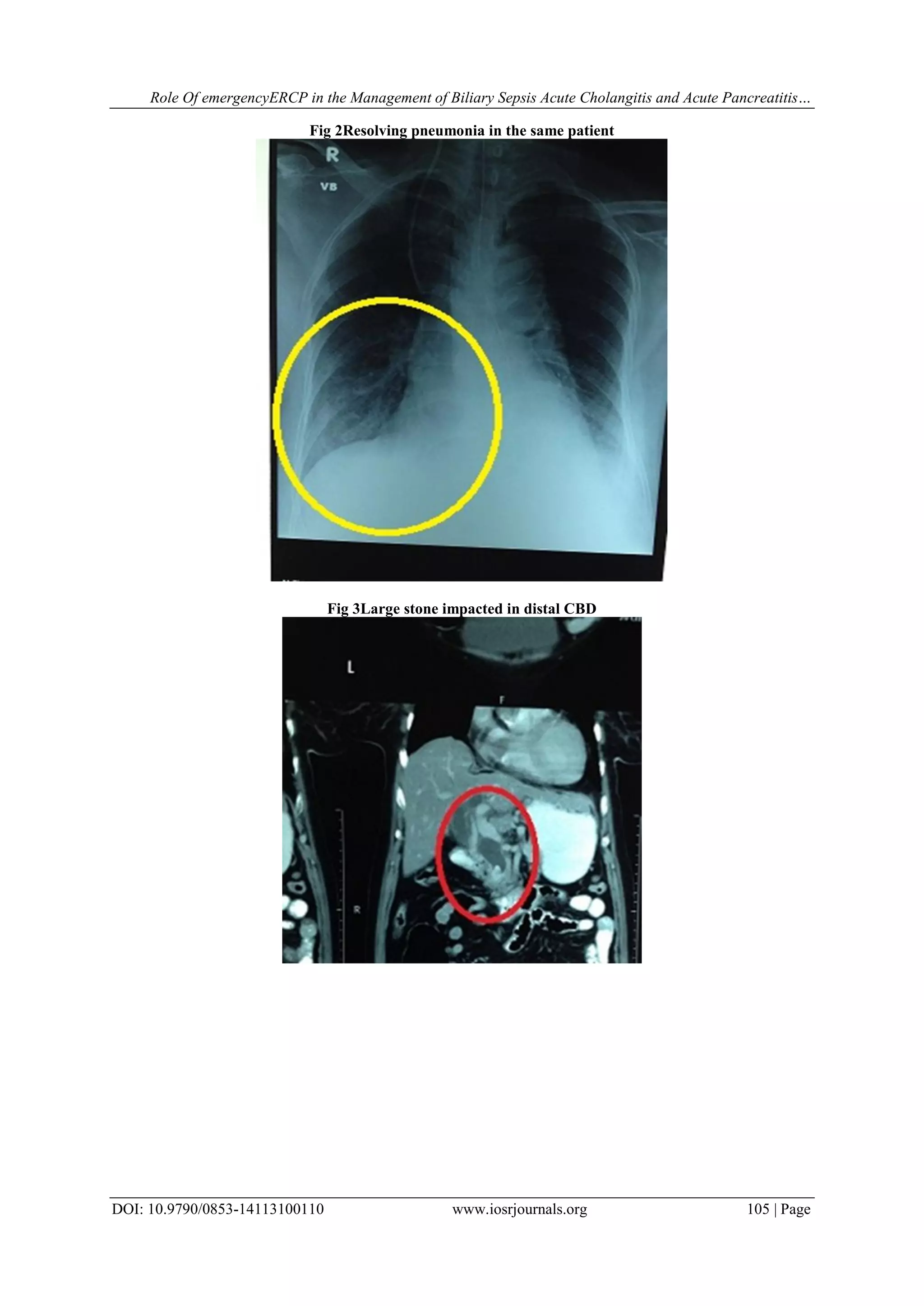 Role Of Emergency ERCP in the Management of Biliary Sepsis Acute ...