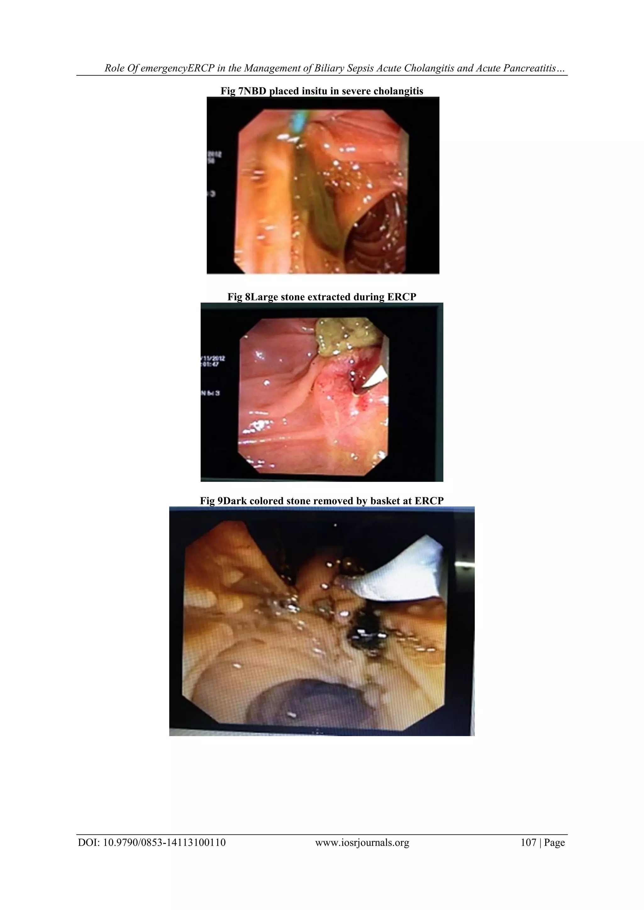 Role Of Emergency ERCP in the Management of Biliary Sepsis Acute ...