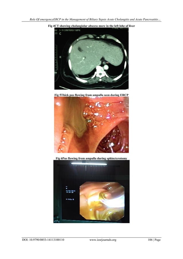 Role Of Emergency ERCP in the Management of Biliary Sepsis Acute ...