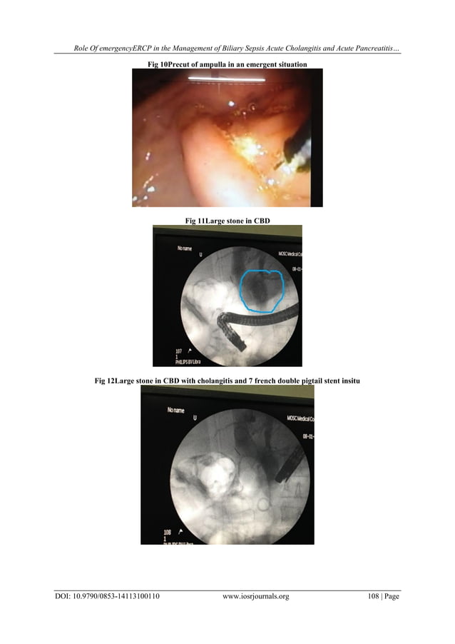 Role Of Emergency ERCP in the Management of Biliary Sepsis Acute ...