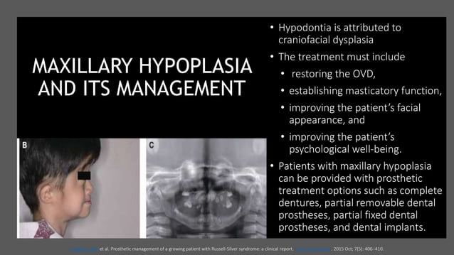 DEVELOPMENT OF MAXILLA AND ITS PROSTHODONTIC RELATION.pptx | Ear, Nose ...