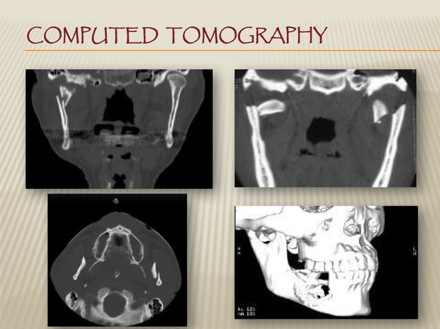 S10 CONDYLAR FRACTURES.pptx............. | PPT
